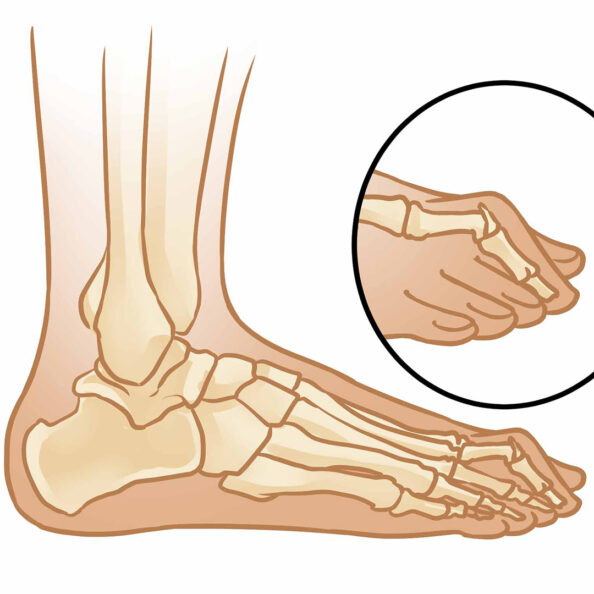 Čekićasti prsti - Hammertoes - ZDRAV I PRAV - Hammertoes